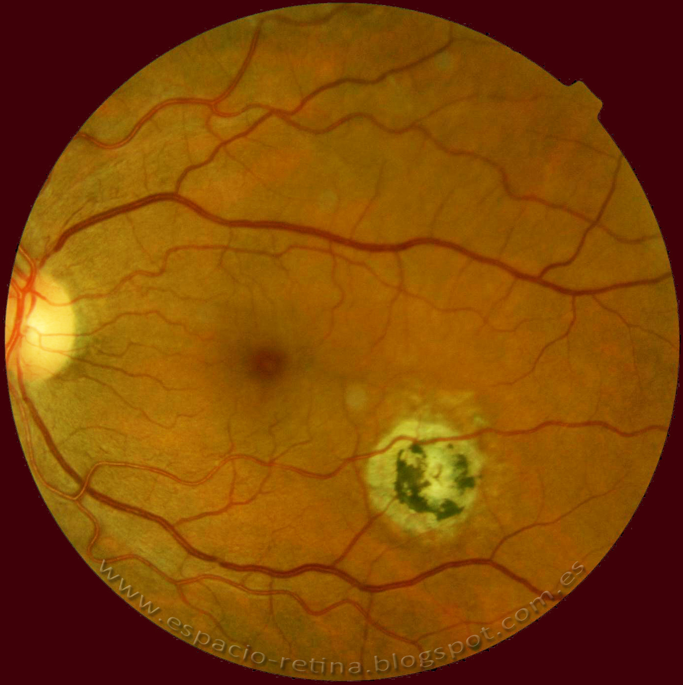 ESPACIO RETINA: Cicatriz postcoriorretinitis.