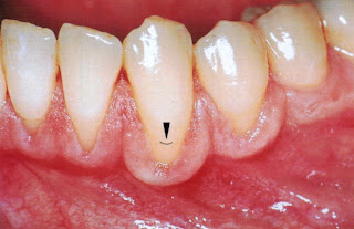 La Bibliothèque du Dentiste et www.universdentaire.tn: Les gingivopathies