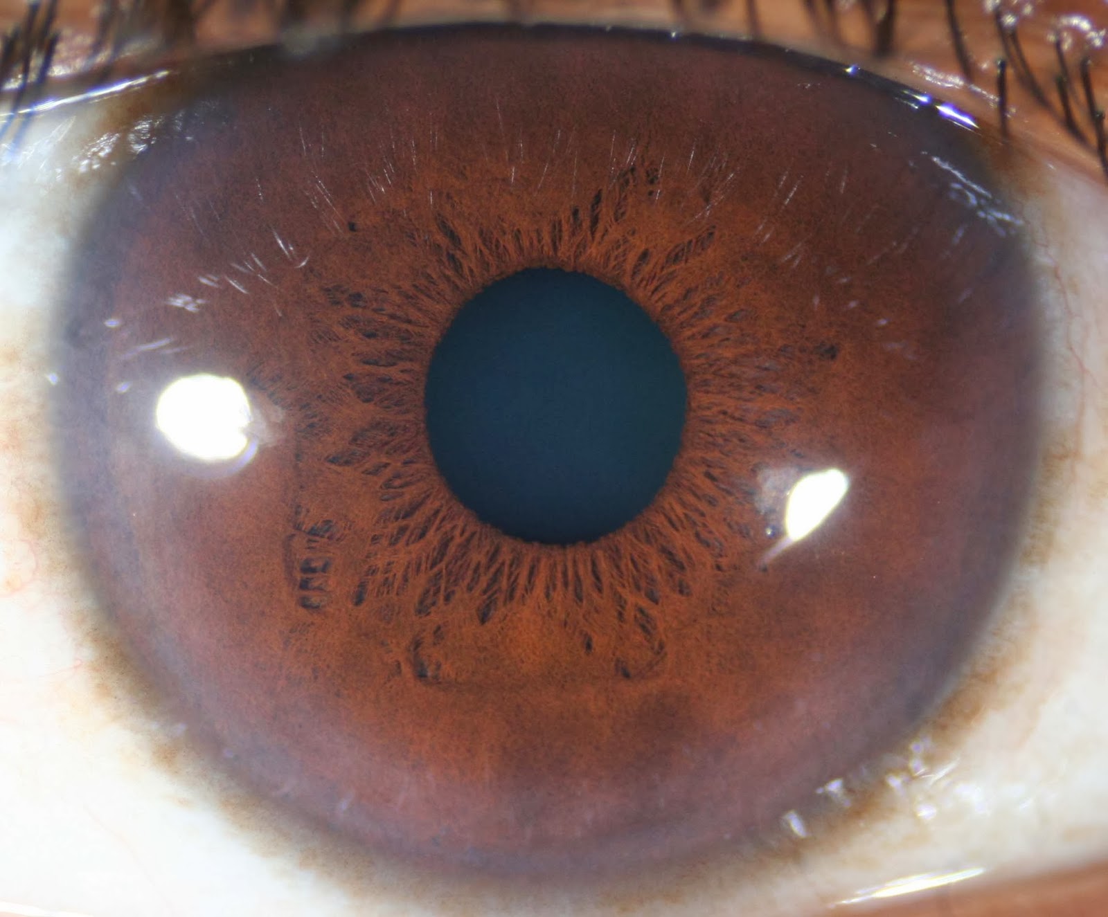 Modern & Multidimensional Iridology: Stairstep Lacuna & The Collarette ...