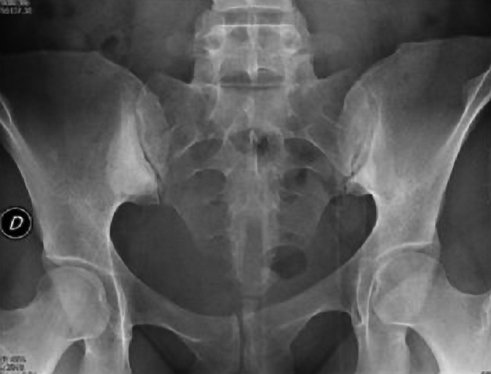 DrColumna: ARTICULACION SACROILIACA Y SUS TRASTORNOS - SACROILEÍTIS