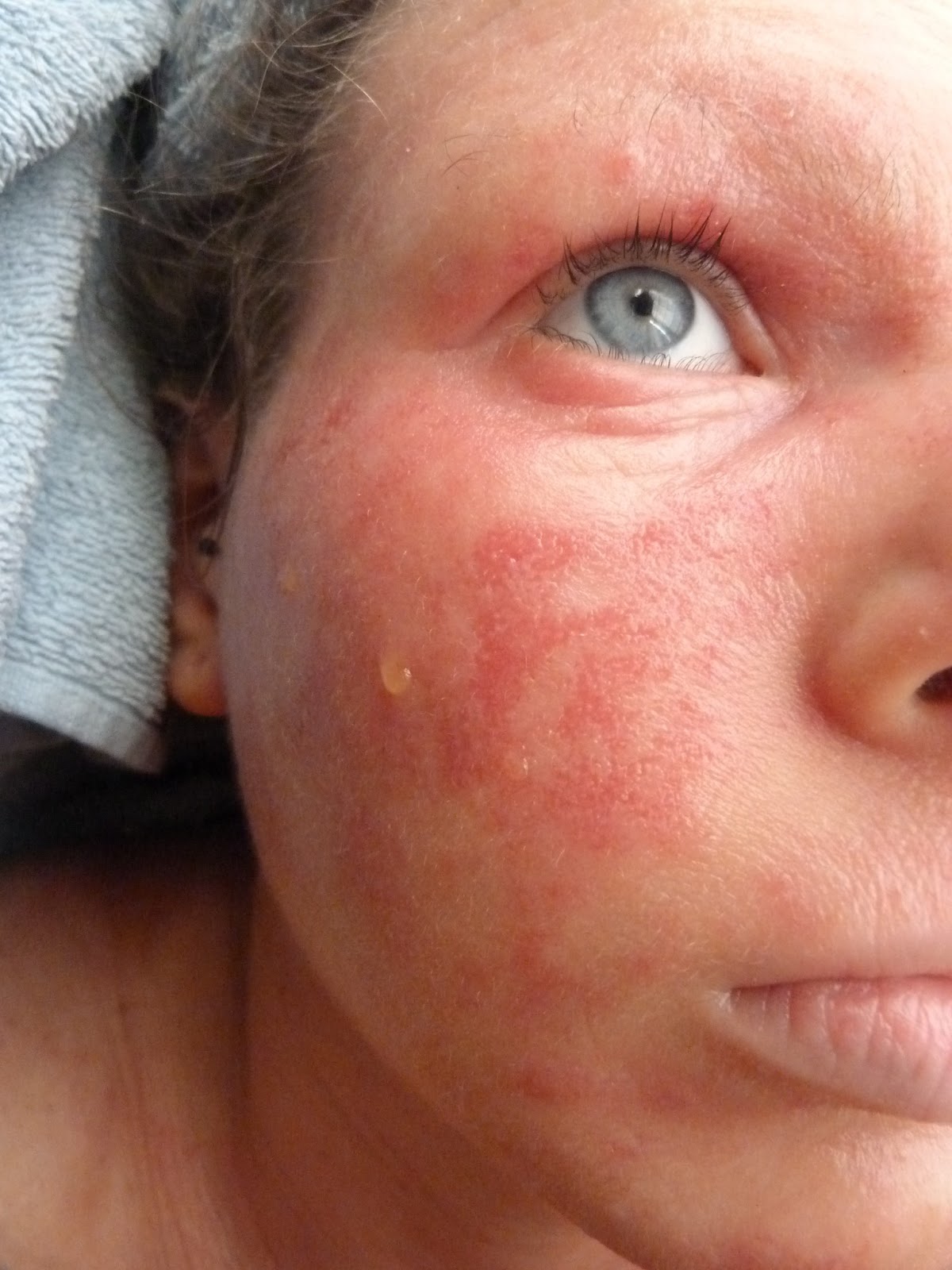 I Have Eczema: The Great Ooze - My Skin Is Crying