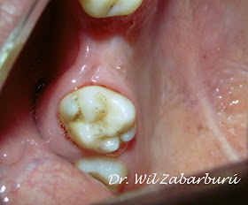 CLINICA DENTAL ASISTENCIAL: TUBÉRCULO PARAMOLAR