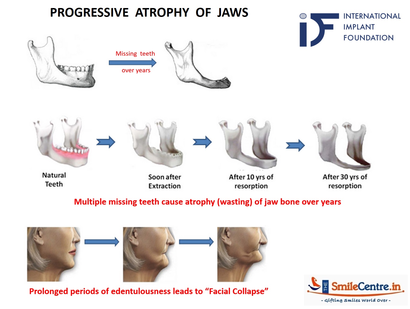 Strategic Implantology - A boon for the Patient as well as the Doctor ...