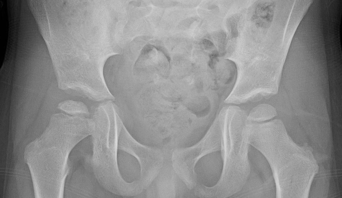 Adventures with Legg Calve Perthes Disease: X-RAYS