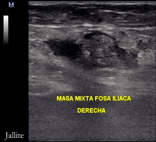Absceso Pared Abdominal