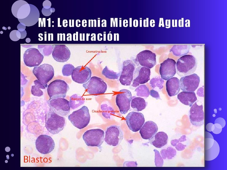 Células Sanguíneas: Leucemias Mieloides Agudas