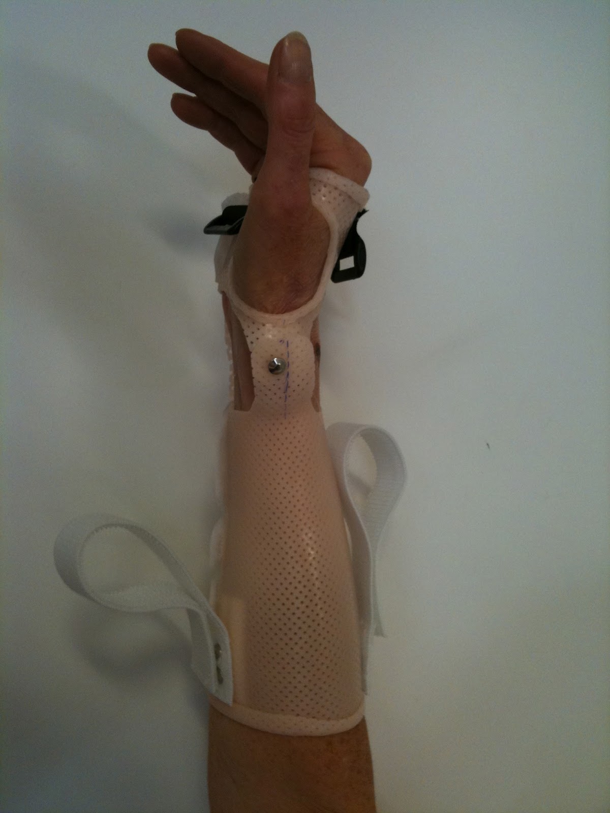 Orthèses sur mesure et appareillage personnalisé main poignet doigts ...