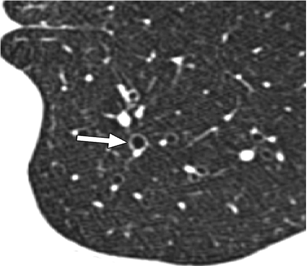 Chest Medicine Made Easy-Dr Deepu: The HRCT findings of Bronchiectasis.