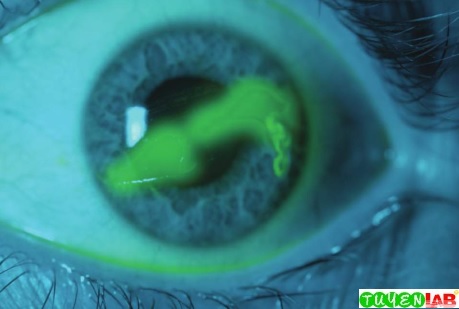 [Emergency] Atlas of Corneal Abrasion | Free Medical Atlas