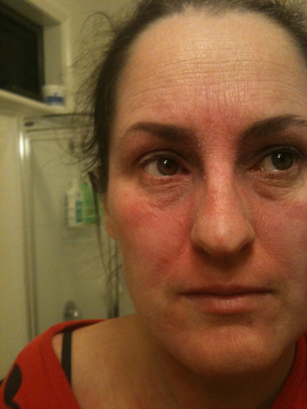 Topical Steroid Withdrawal Journey-Healing Eczema and Red Skin Syndrome ...
