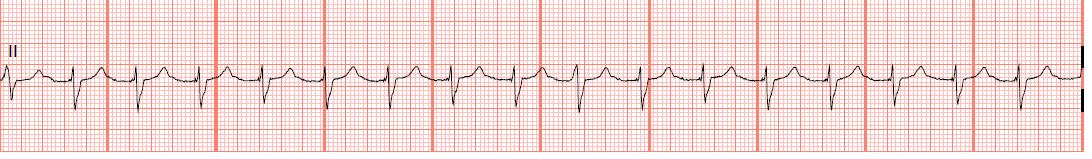 EKG Rhythm Strips 14: Junctional Rhythms
