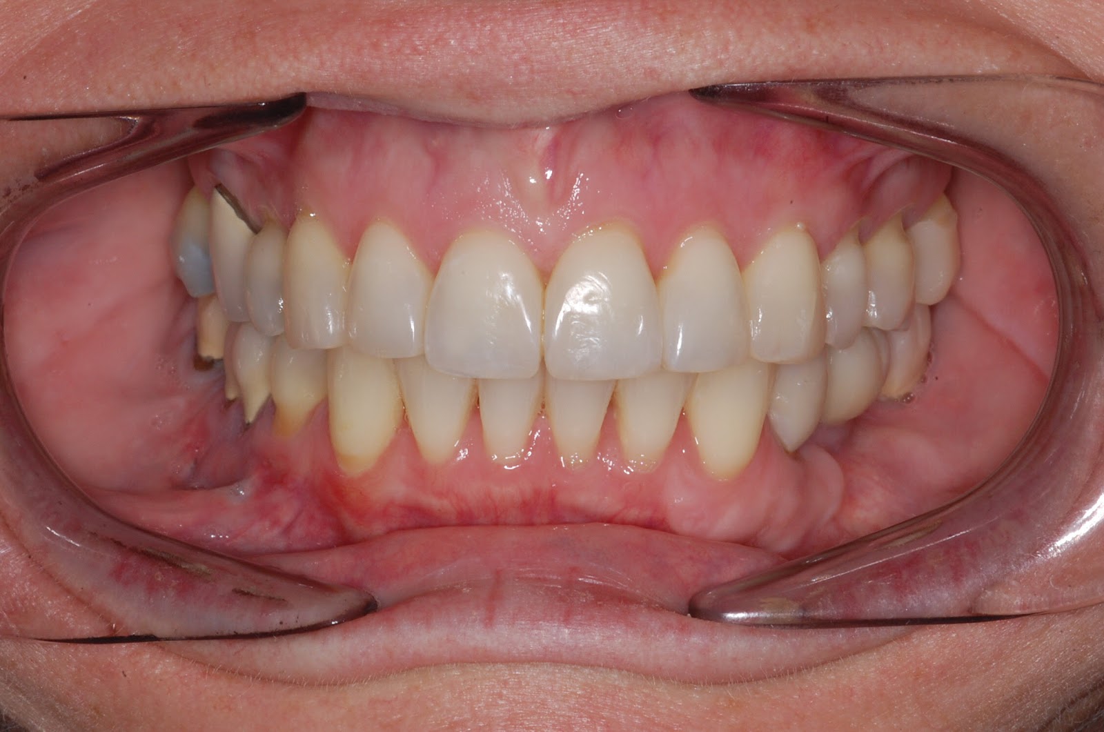 Truman Orthodontics: Narrow Smile