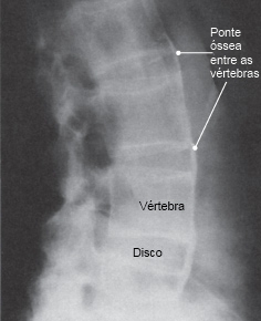 LR FISIO: ESPONDILITE ANQUILOSANTE: SAIBA O QUE É