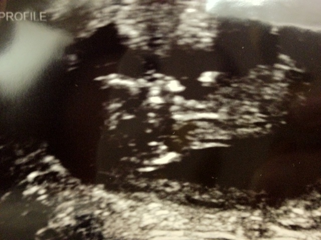 Bryce Alexander Moline: 24 Weeks, 1 day - Again