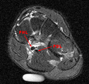 Extensor Digitorum Brevis Mri