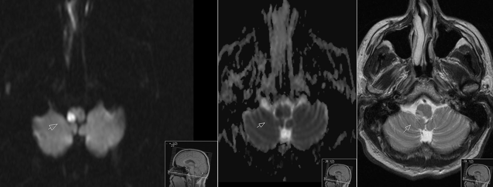 Lateral Pontine Syndrome Mri