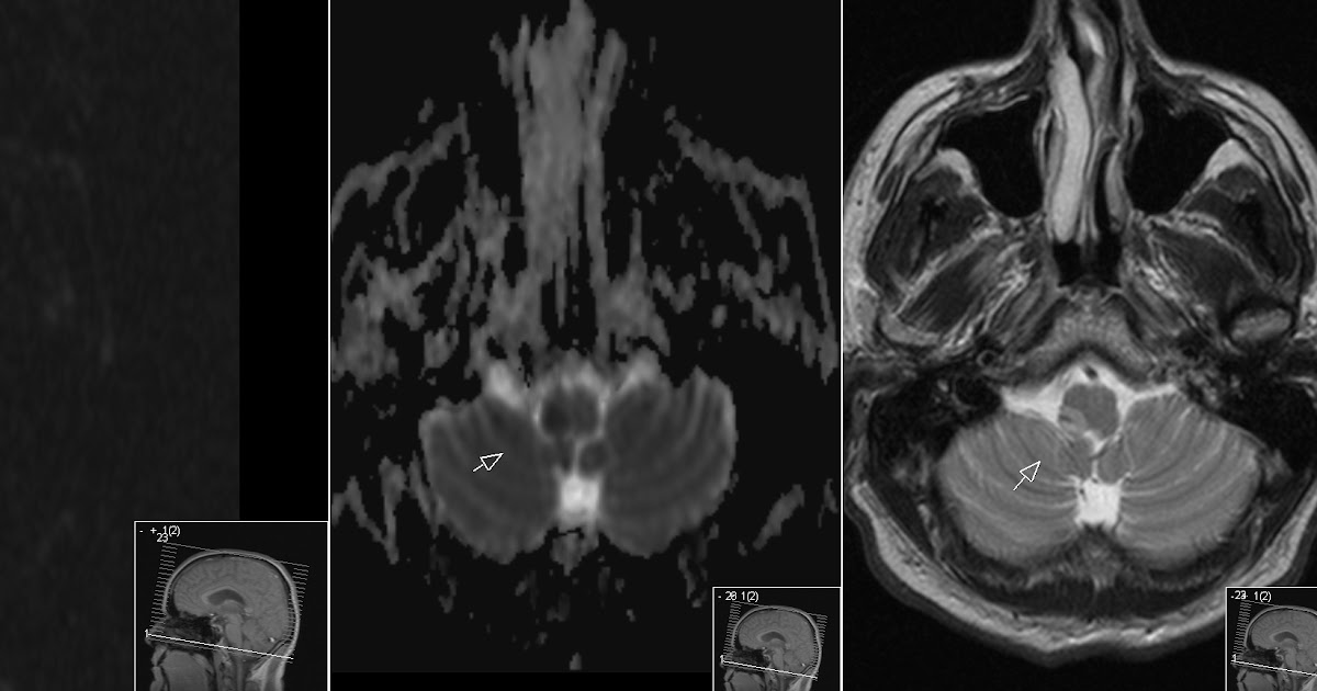 Lateral Pontine Syndrome Mri