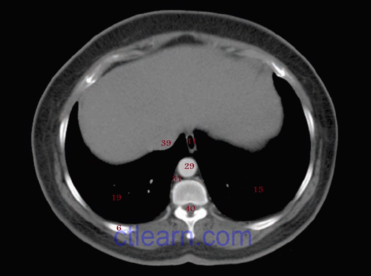 Anatomy CT Axial Chest