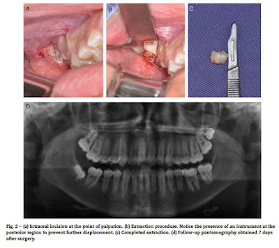 PDF: Delayed removal of maxillary third molar displaced into the ...