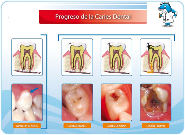Diagnóstico de caries, superficies oclusales y proximales: Artículo