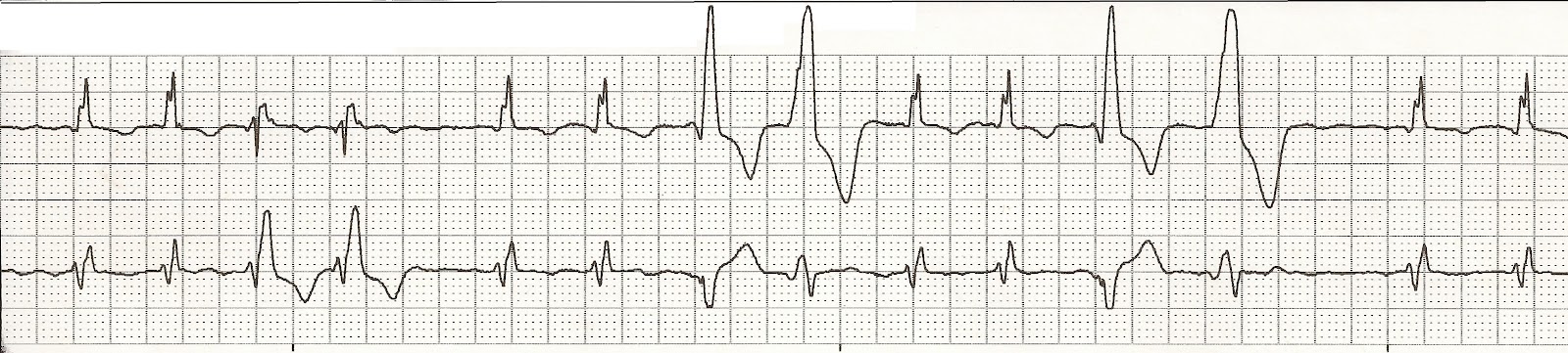 EKG Rhythm Strips 60