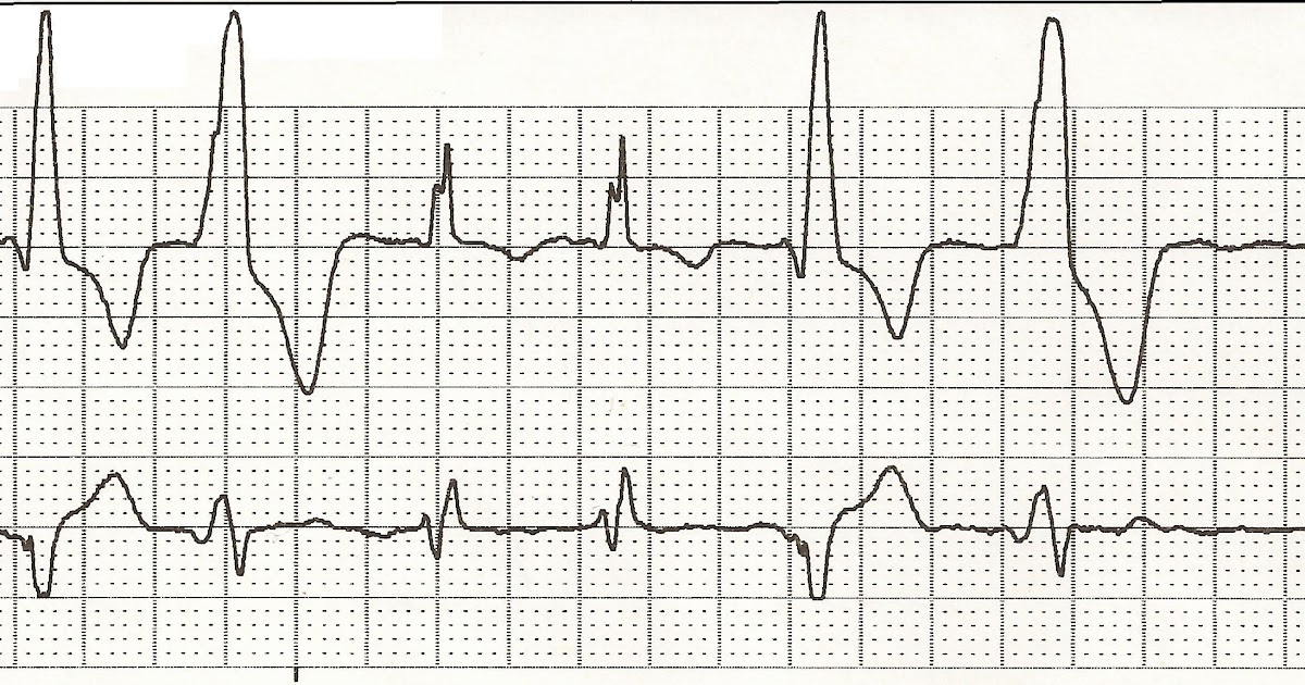 Float Nurse: EKG Rhythm Strips 60