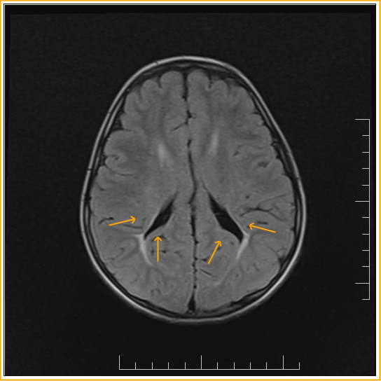 Periventricular leukomalacia: MRI - Sumer's Radiology Blog