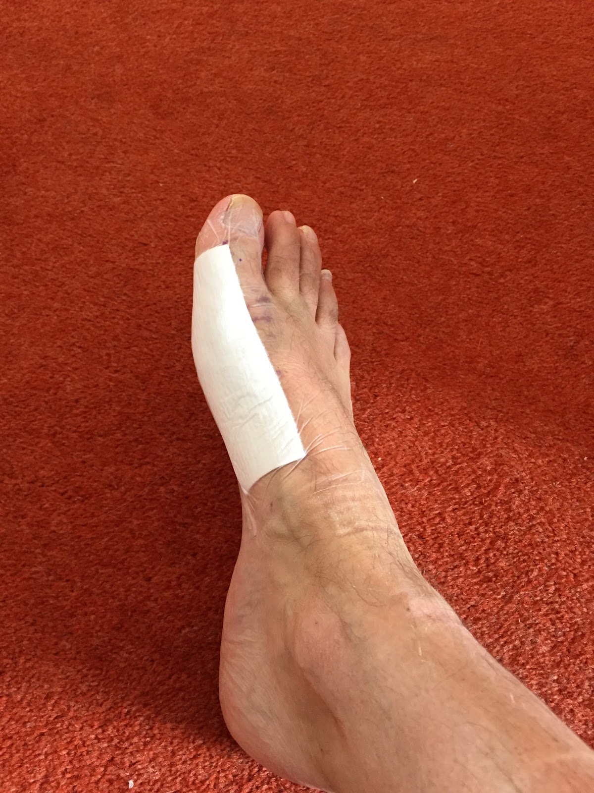 One Boot In Front Of The Other: The Cheilectomy......!!!