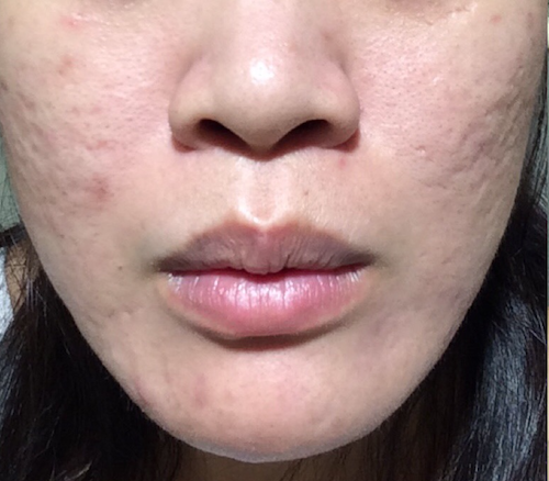 How To Cover Acne Pock Marks With Makeup - Mugeek Vidalondon