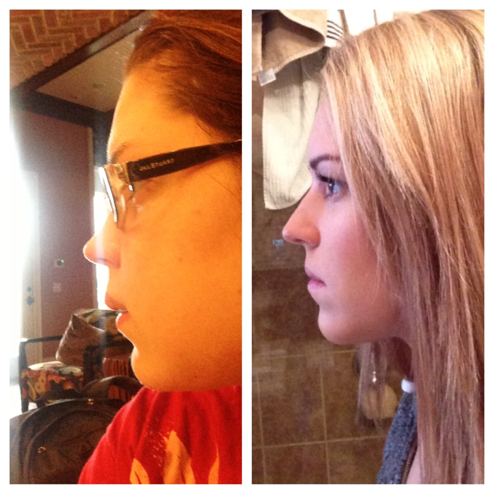 Journey through braces+open bite jaw surgery: September 2013