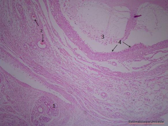 O que é a rânula ou mucocele sublingual? ~ Dentopolis
