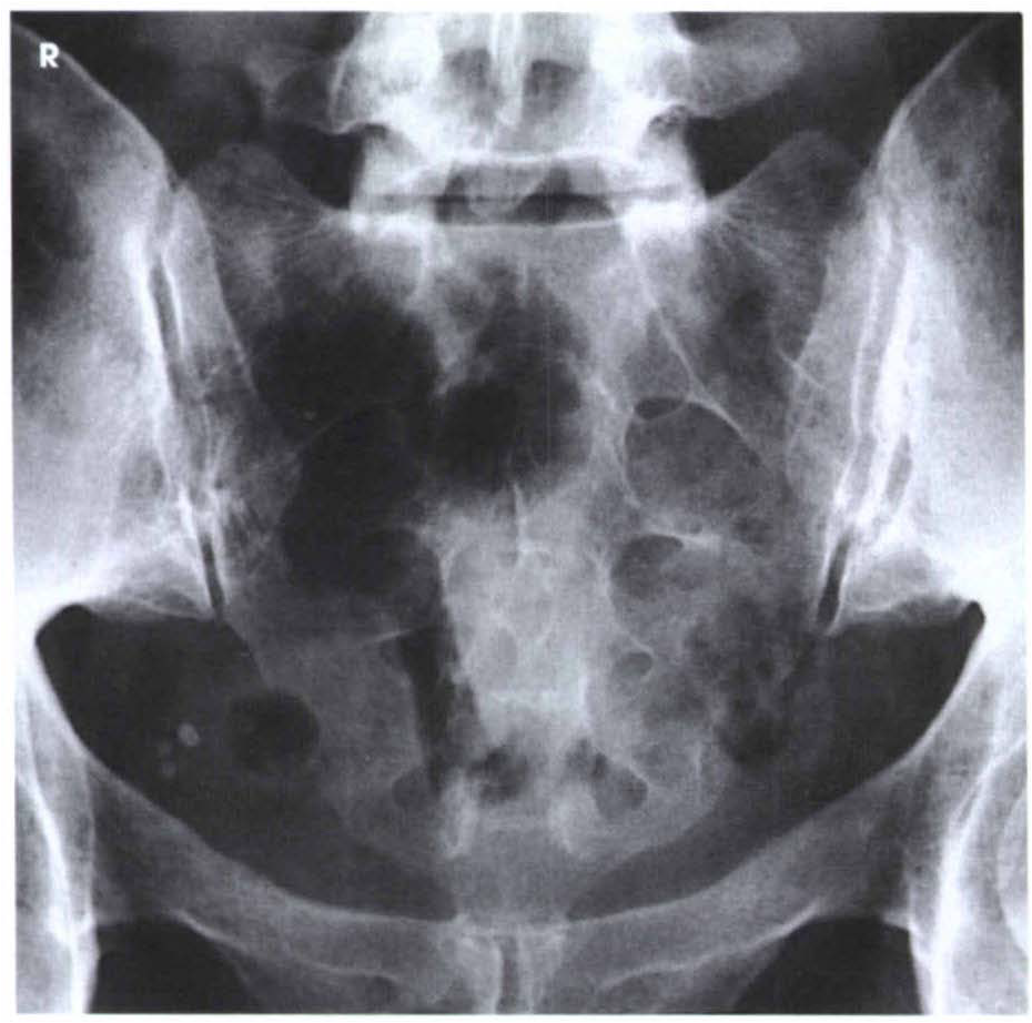 AKHSANUR BLOG'S: teknik radiografi sacrum dan coccyx
