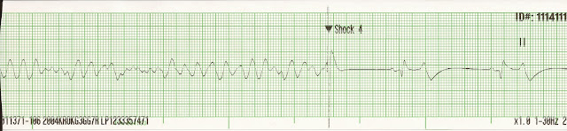 Pediatric Pulseless Ventricular Tachycardia (VT) and Ventricular ...