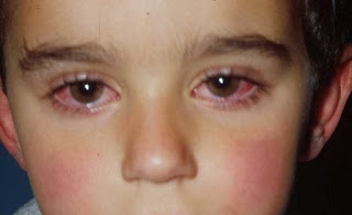 Pediatrics Notes: Approach to a Child With Eye Discharge and Swelling