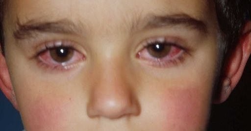 Pediatrics Notes: Approach to a Child With Eye Discharge and Swelling