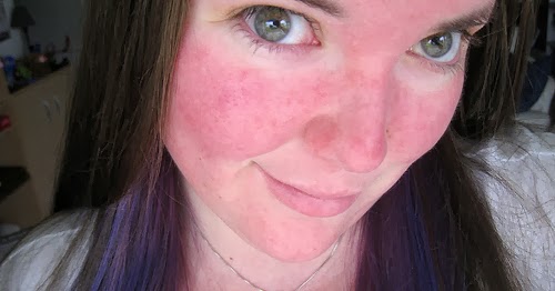 Remèdes naturels pour soigner la couperose, la rosacee, les rougeurs du ...