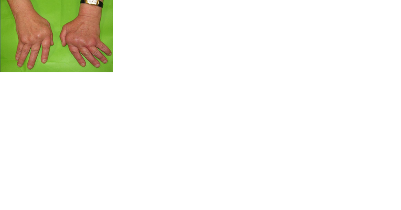 De verschillende soorten gewrichten - letsels: Reumatische artritis thv ...