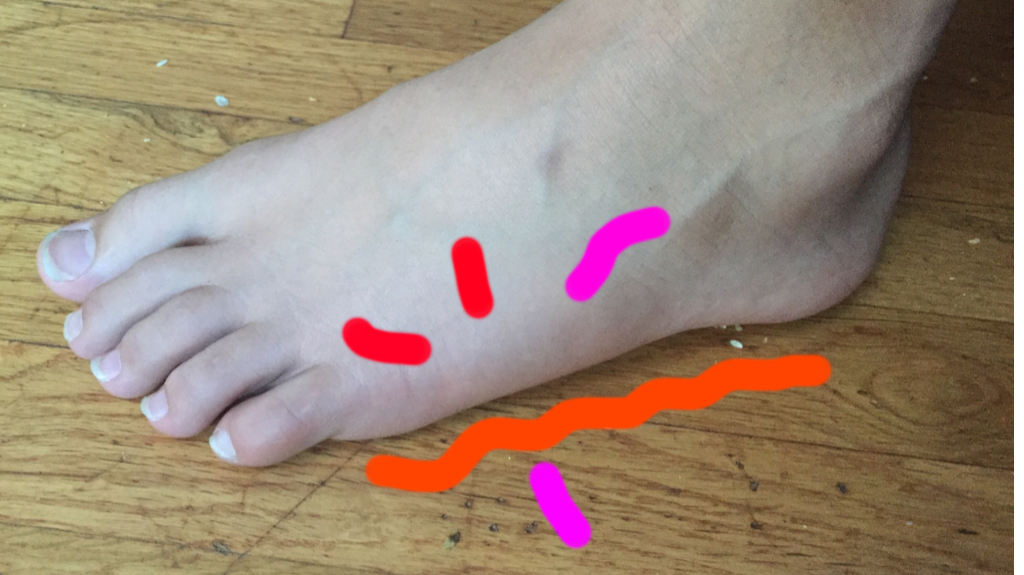 interior castle: 5th metatarsal tuberosity fracture