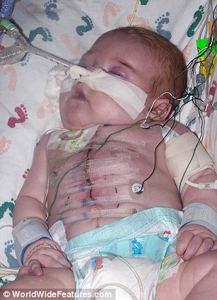 Obehi Okoawo's Blog: Meet The World's First Kid To Survive Surgery ...