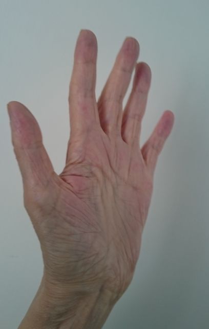 Handrehabilitationcase with Dupuytren's contracture.: A trauma in the ...