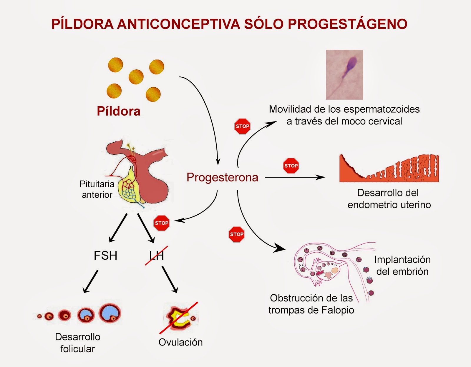 Hormonas : Anticonceptivos hormonales