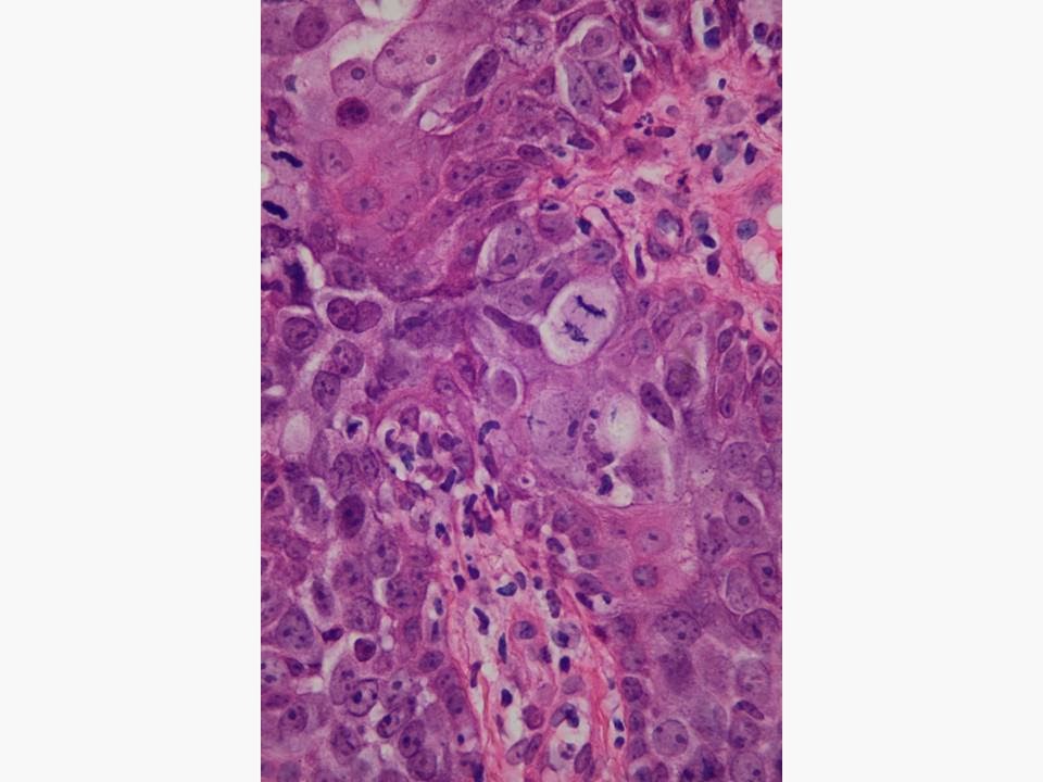 Dermpath Made Simple - Neoplastic: Other Malignant Epidermal Tumours