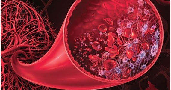 Grupo de Estudos Aplicados à Hematologia: Hemoglobinúria Paroxística ...