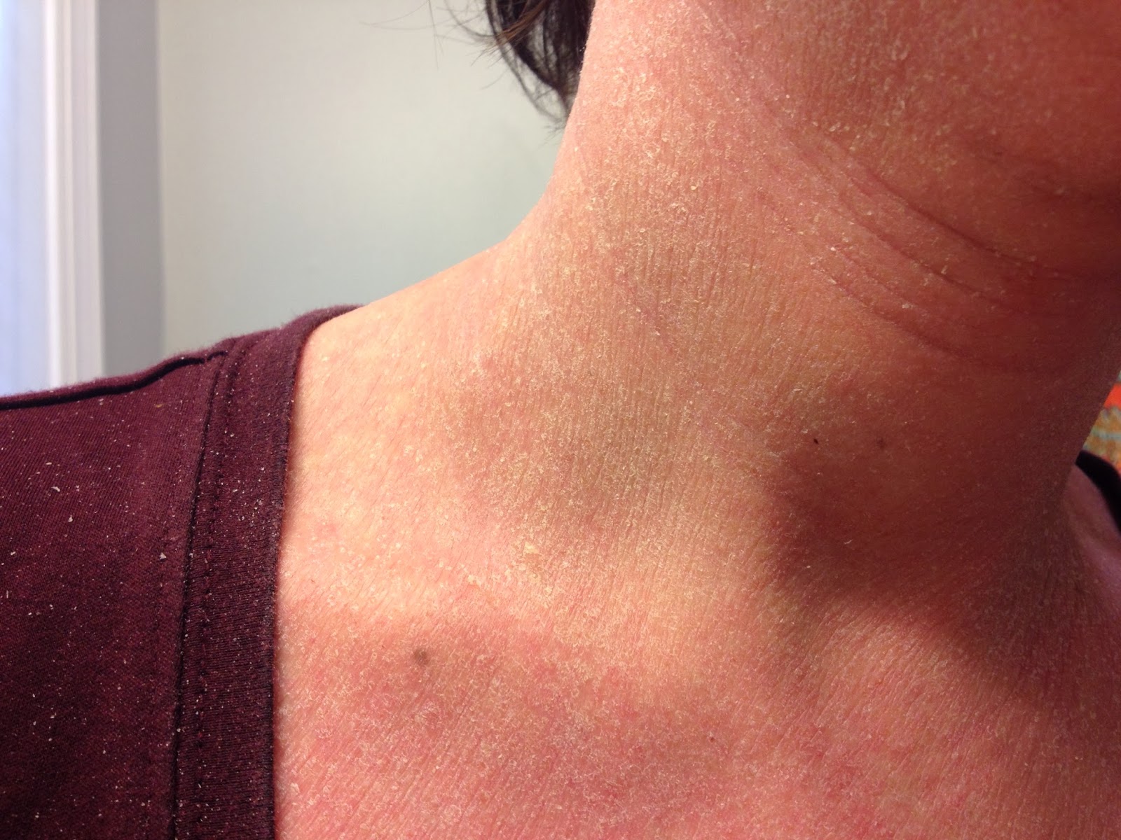 My journey with itchy skin.: Flakes & dry skin.