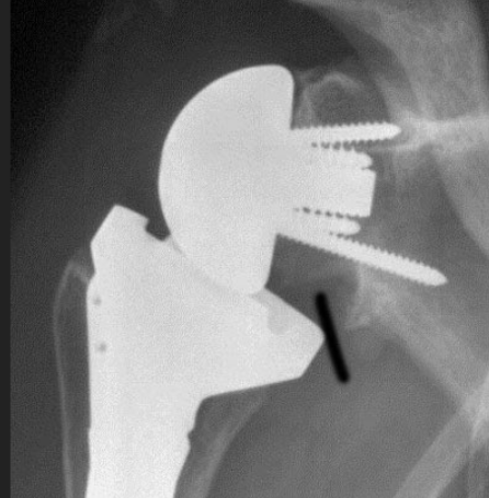 Shoulder Arthritis / Rotator Cuff Tears / Shoulder Pain : Scapular ...