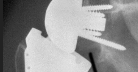 Shoulder Arthritis / Rotator Cuff Tears / Shoulder Pain : Scapular ...