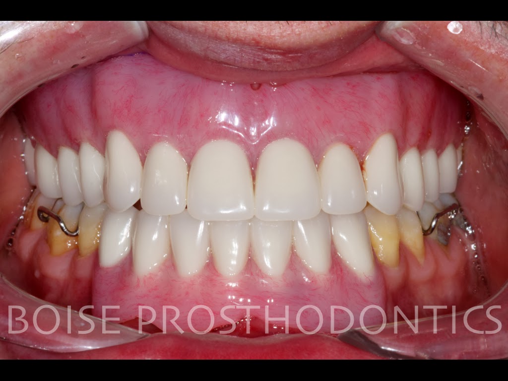 Boise Idaho Prosthodontics: True Immediate Maxillary Complete Denture ...