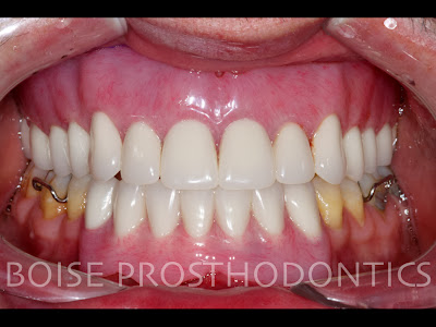 Boise Idaho Prosthodontics: True Immediate Maxillary Complete Denture ...