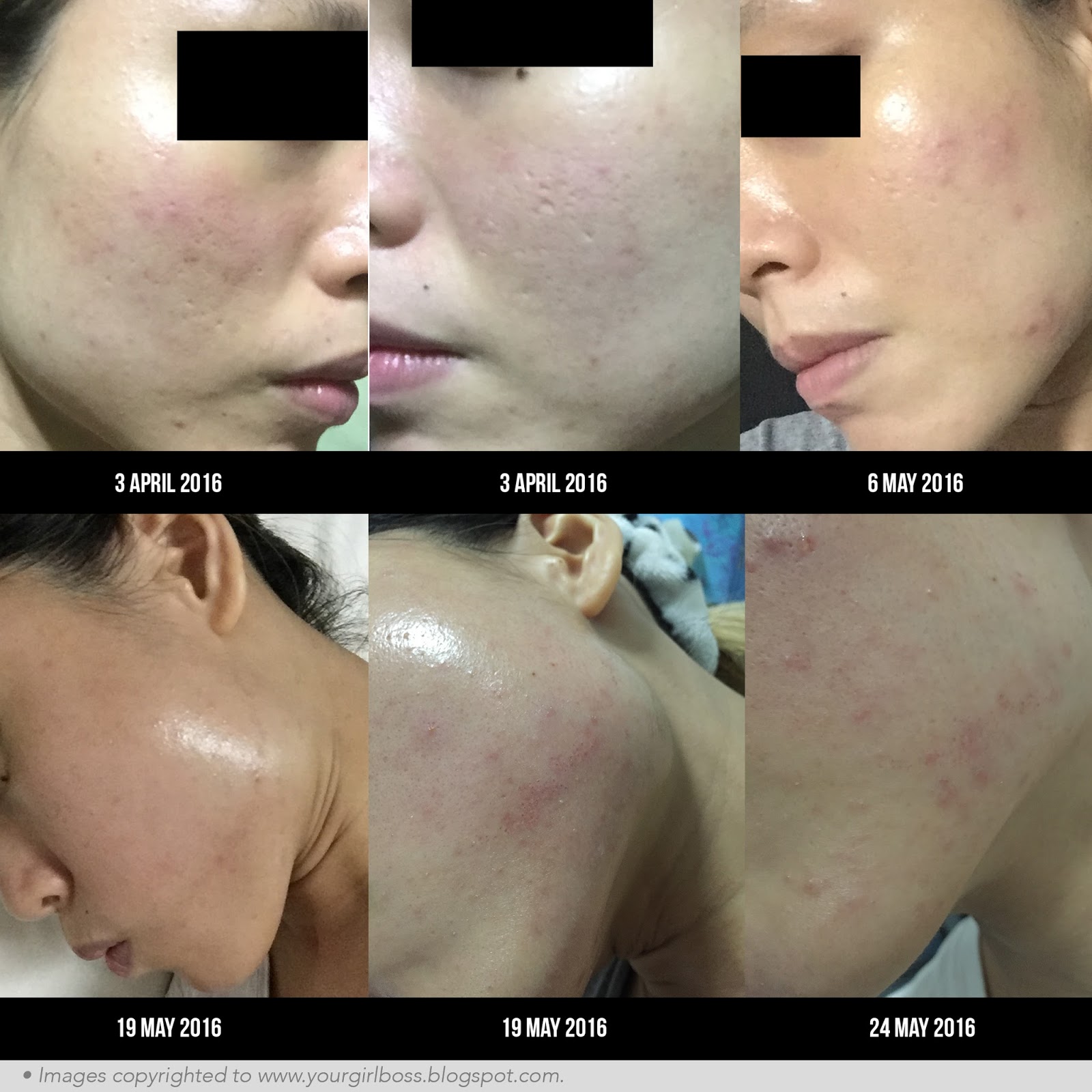 My Asian Beauty Journey / My Acne Journey - Jean Kuah's Beauty Blog