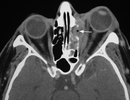 Patient’s outcome in acute invasive fungal sinusitis